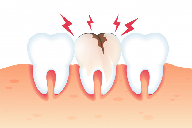 Teeth filling - Process, Cost, After care, Types & More